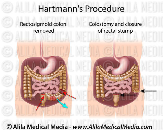 Alila Medical Media | Hartmann's procedure. | Medical illustration