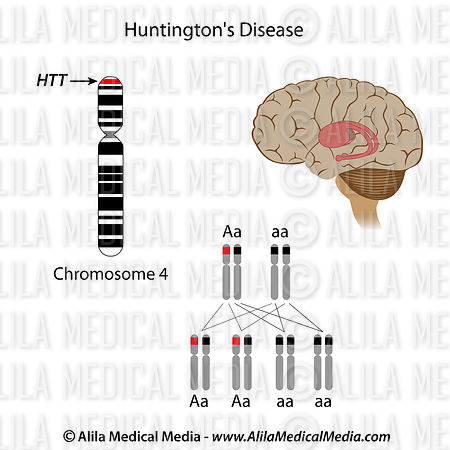 Alila Medical Media | Huntington disease | Medical illustration