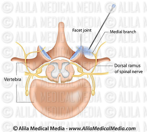 Alila Medical Media | Medial branch nerve block. | Medical illustration