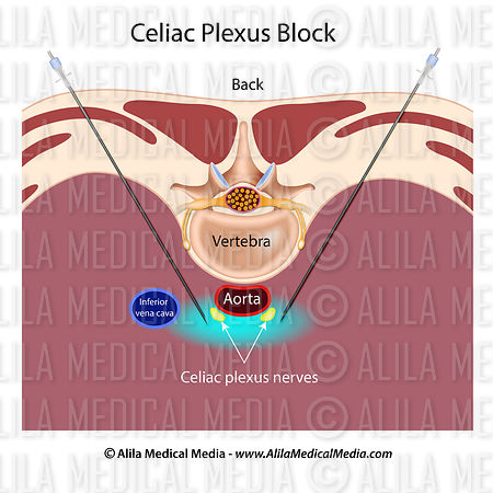 Alila Medical Media | Celiac plexus block | Medical illustration