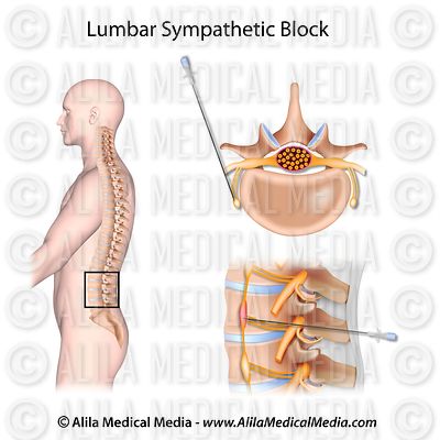 Alila Medical Media | Pain Management Images and Videos