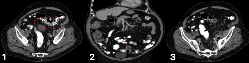 Diverticular Disease Clinical Features Management TeachMeSurgery Diverticular Disease Clinical Features Management TeachMeSurgery