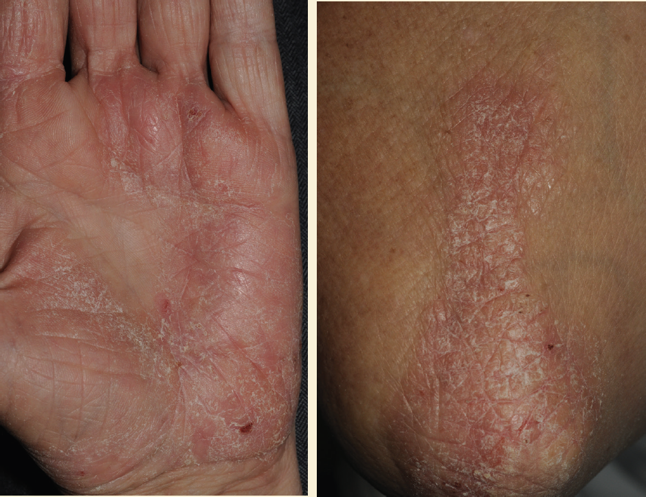 What Explains This Recurrent Rash? | Consultant360