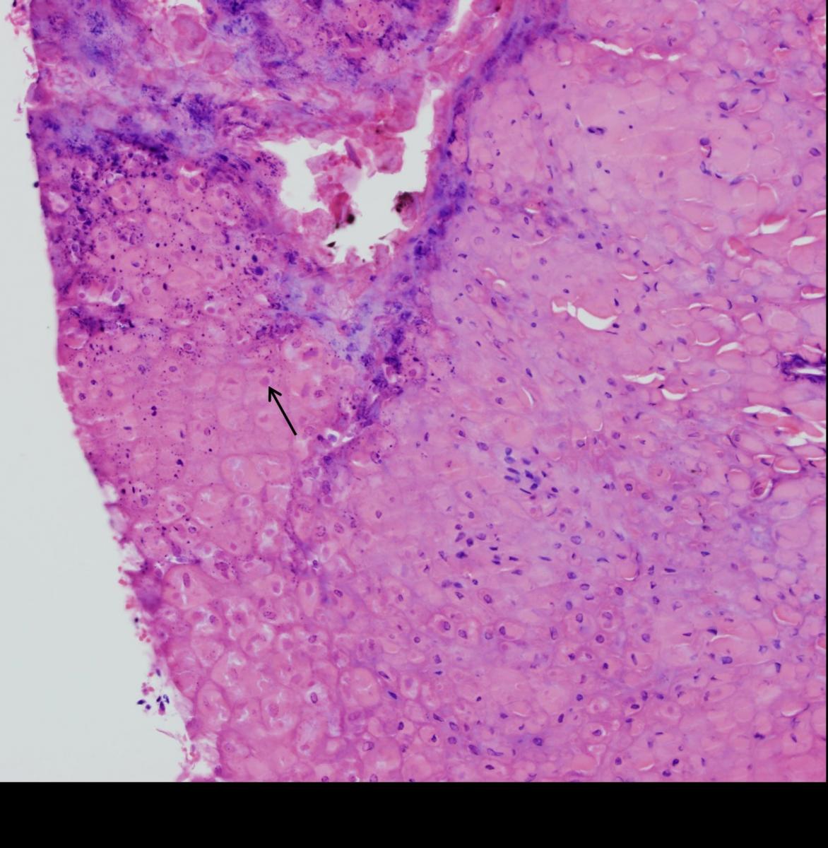 A Farmer’s Thumb Lesion After a Sheep Bite: Identifying the Zoonosis ...