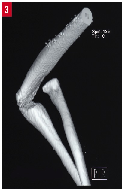 Congenital Posterior Dislocation of the Radial Head | Consultant360