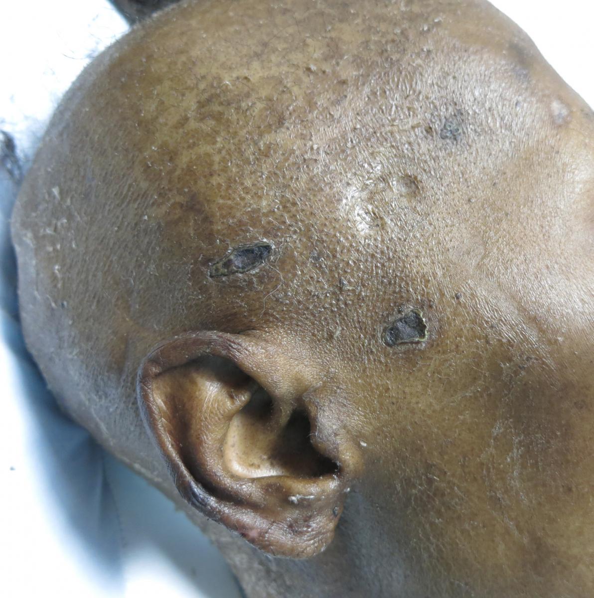 Progressive Diffuse Calciphylaxis With Facial Involvement Despite ...