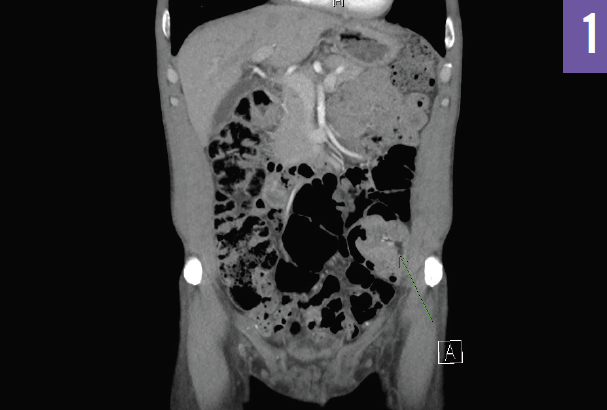 Adult Intussusception | Consultant360