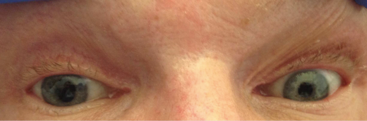 Anisocoria | Consultant360