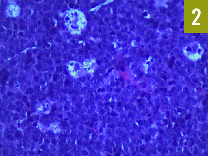 Burkitt Lymphoma | Consultant360