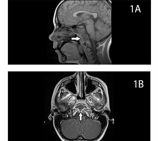 A Rare Cause of Neck Pain and Headache | Consultant360