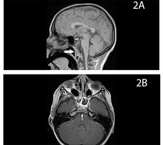 A Rare Cause of Neck Pain and Headache | Consultant360