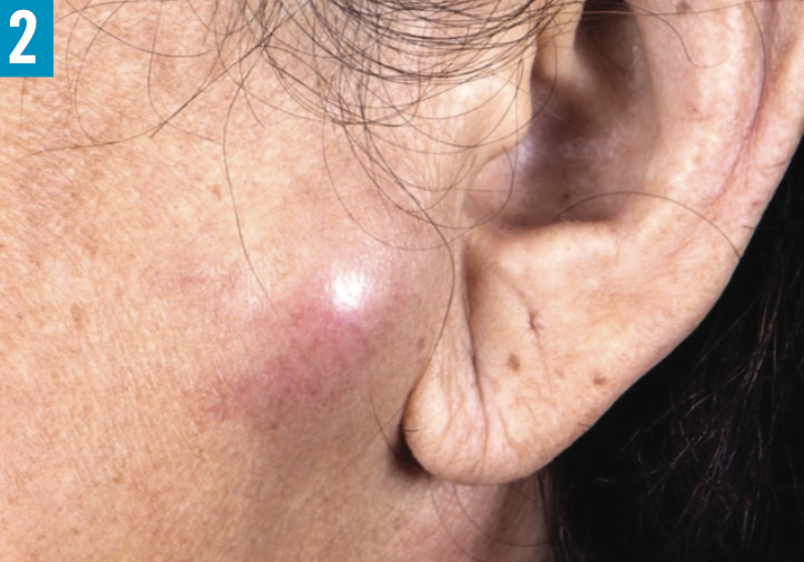 Interactive Quiz: Pruritic Rash Involving the Eyebrows | Consultant360