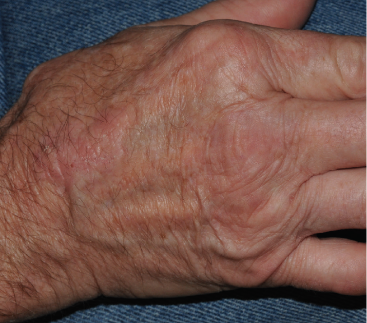 What Is the Cause of This Man’s Rash? | Consultant360