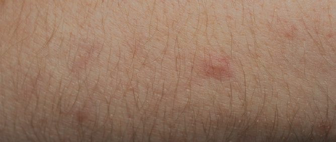 What Is the Cause of This Rash? | Consultant360