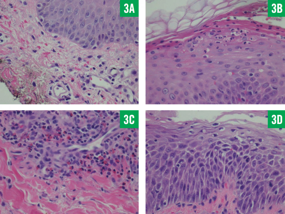 Addressing DRESS: A Case of a Hydroxychloroquine-Induced Reaction ...