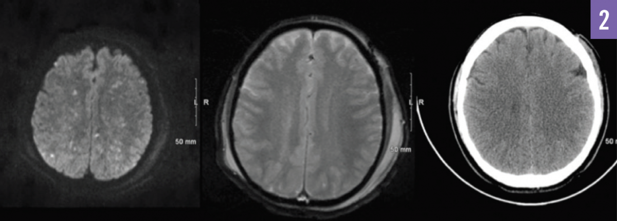 Diffuse Cerebral Fat Emboli in Fat Embolism Syndrome | Consultant360