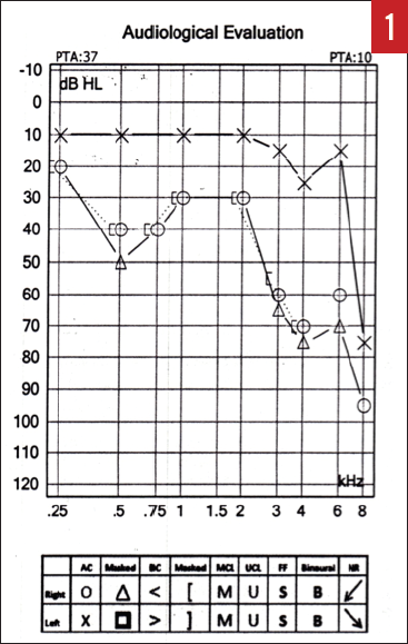 Sudden Sensorineural Hearing Loss: A Potential Result of Acoustic ...
