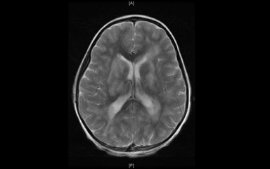 Acute Disseminated Encephalomyelitis | Consultant360