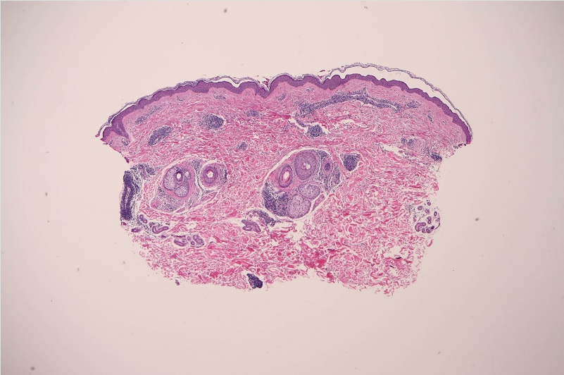 What Is Causing This Woman’s Longstanding Pruritic Upper-Body Rash ...