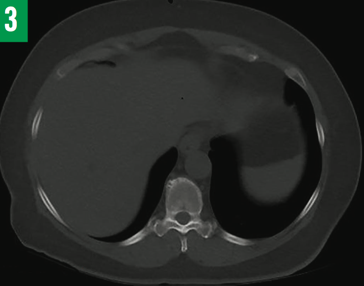 Immunoglobulin G4-Related Hepatic Abscess With Comorbid Primary Hepatic ...