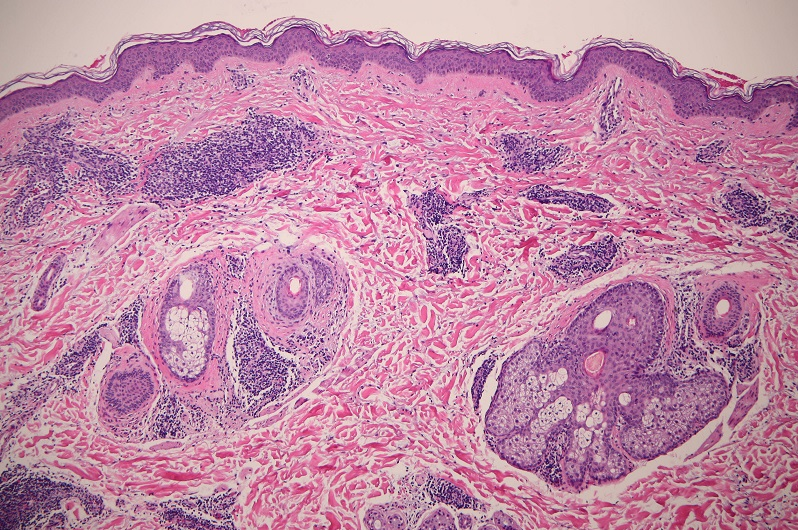 What Is Causing This Woman’s Longstanding Pruritic Upper-Body Rash ...