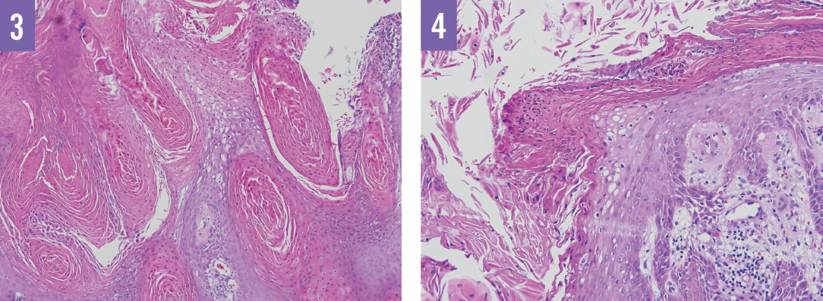Giant Condylomata Acuminata | Consultant360