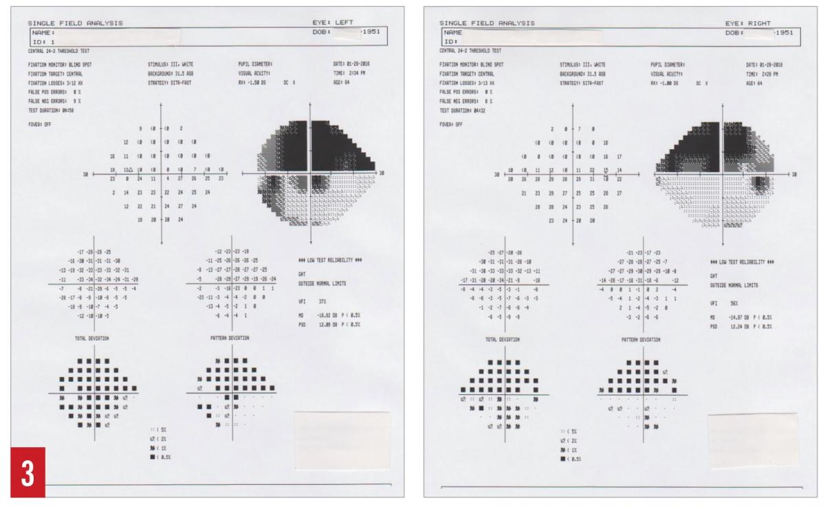 Glaucoma: A Primary Care Review With a Focus on Medication Management ...