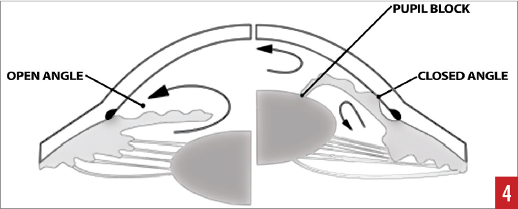 Glaucoma: A Primary Care Review With a Focus on Medication Management ...
