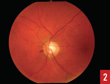Glaucoma: A Primary Care Review With a Focus on Medication Management ...