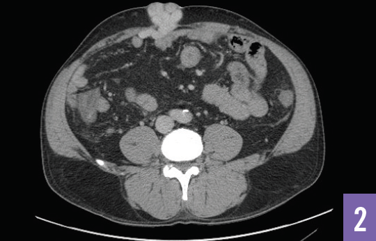 Umbilical Hernia | Consultant360