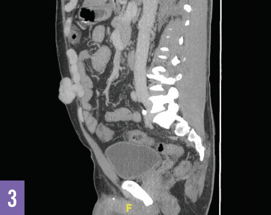 Umbilical Hernia | Consultant360