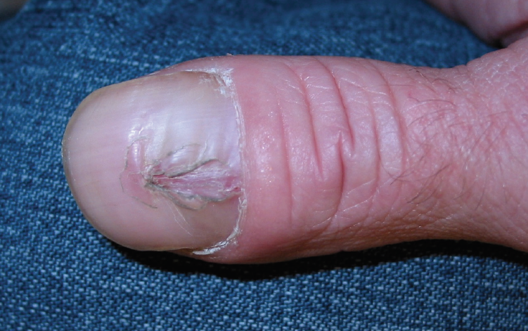 Split and Fissured Thumbnails: Benign Condition, or a Sign of ...