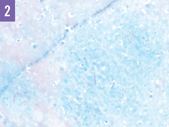 Primary Cutaneous Nocardiosis | Consultant360