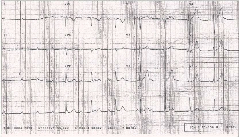 Case in Point: Heart Block as the Presenting Symptom of Lyme Disease ...