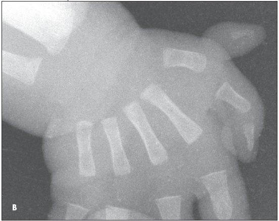 Polydactyly of the Hand | Consultant360