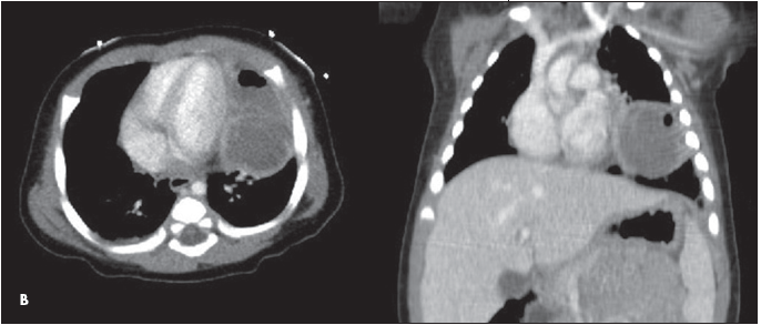 Primary MRSA Lung Abscess After Smoke Inhalation | Consultant360
