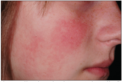 Are the erythema and roughness on a young girl’s cheeks treatable ...