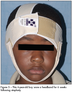 Otoplasty:What You Need to Know About Prominent Ear Deformity ...