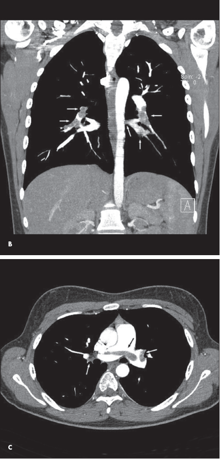 Pulmonary Emboli and Deep Vein Thrombosis | Consultant360