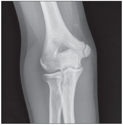 What Rx Findings Reveal About Teenage Boy’s Elbow Pain | Consultant360