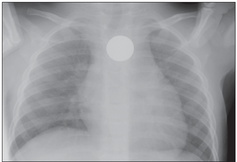 Foreign-Body Ingestions | Consultant360