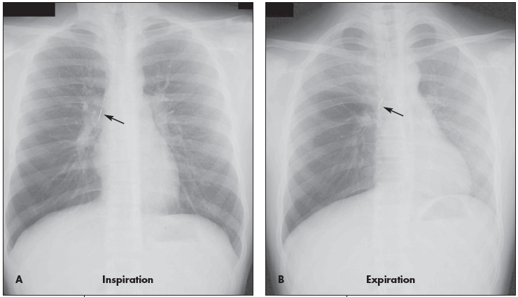Foreign-Body Ingestions | Consultant360
