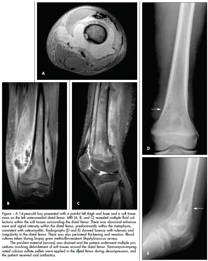 Pediatric Musculoskeletal Infections: Combating the Major Pathogens ...