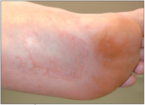 Dermclinic: A Photo Quiz to Hone Dermatologic Skills | Consultant360