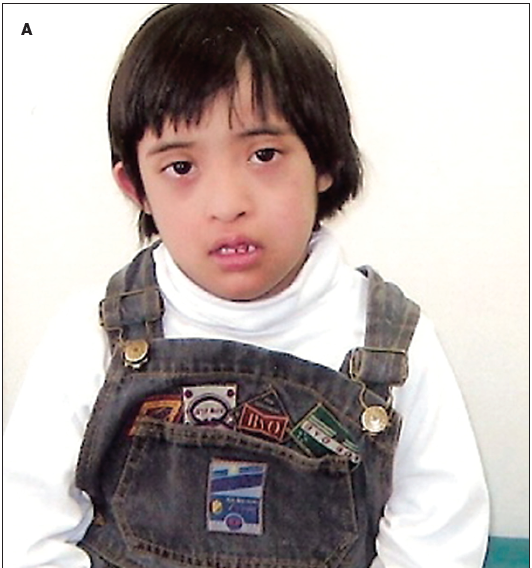 Six-Year-Old Boy With Dysmorphic Features and Delayed Developmental ...