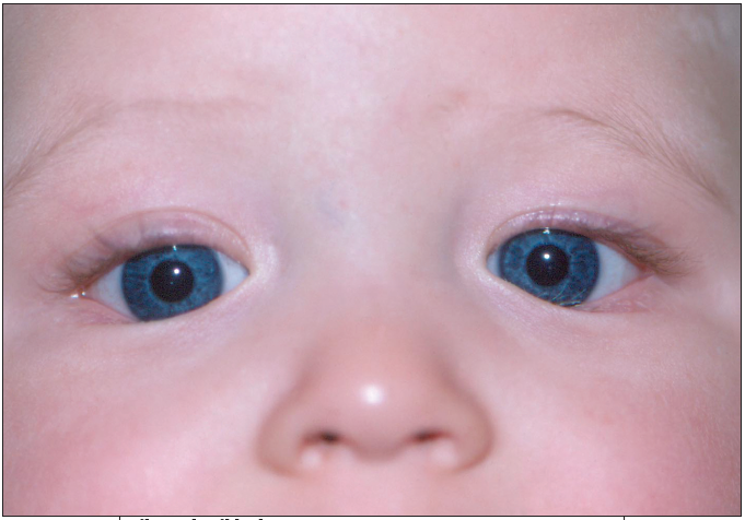 Photoclinic: Bilateral Epiblepharon | Consultant360