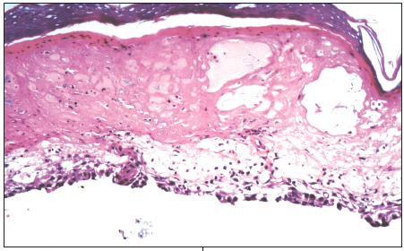 What Caused This Skin Eruption? | Consultant360