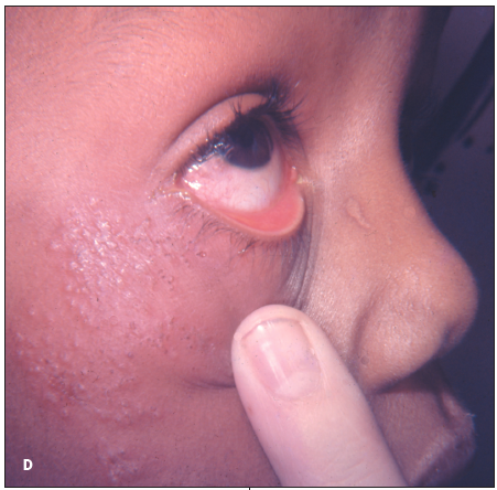 Herpetic Lesions Primary Herpetic Stomatitis Herpetic Whitlow Recurrent ...