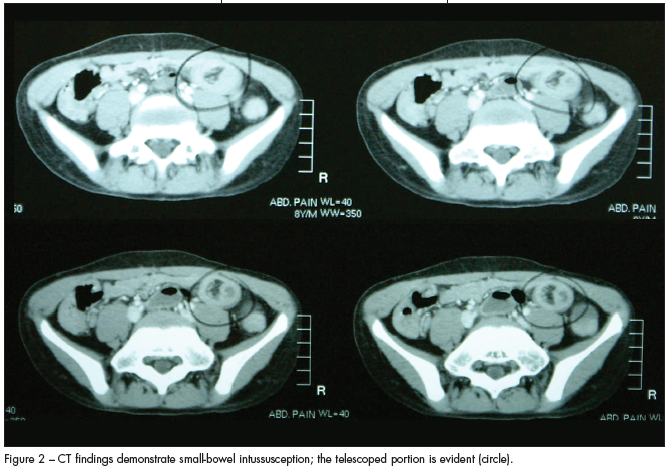 Case In Point: An Unusual Case of Ileal-Ileo Intussusception ...