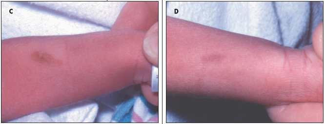 Photoclinic: Sucking Blisters | Consultant360